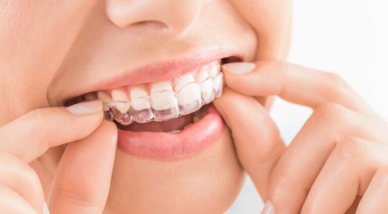 My Invisalign Aligner Does Not Fit — What Should I Do?